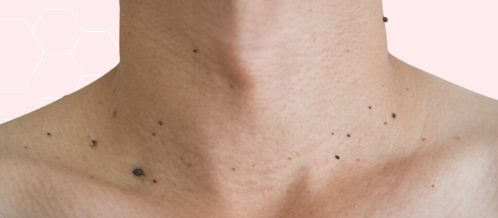 Warts, Milia, and Skin Tags - Skintec