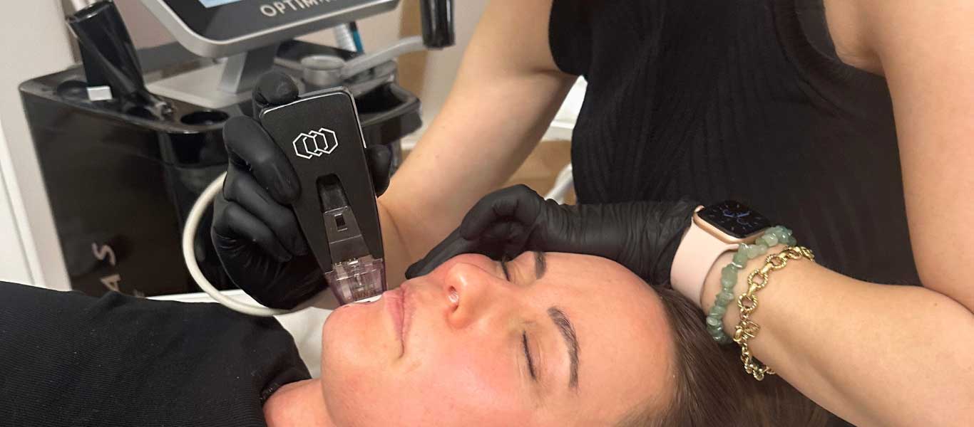 Morpheus resurfacing treatment - Skintec